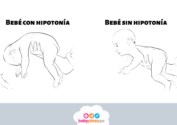 Bebé hipotónico: Causas y tratamiento - Mega Baby